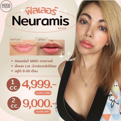 ฟิลเลอร์ | ENNXO