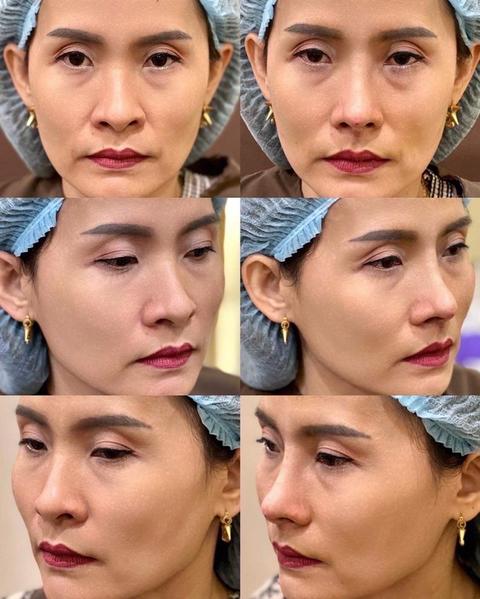 ร้อยไหมจมูก | ENNXO