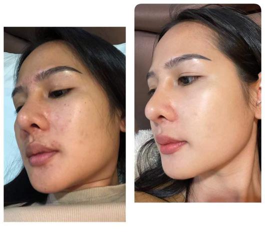 โปรแกรมฟื้นบำรุงผิวหน้า | ENNXO